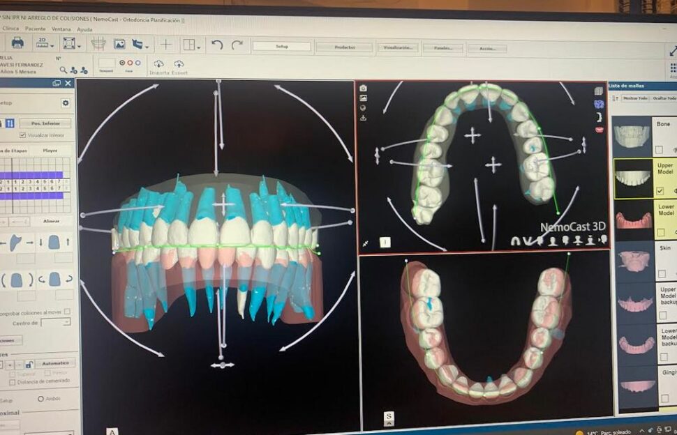 Software Nemocast de Nemotec e impresora 3D | Travesí Ortodoncia