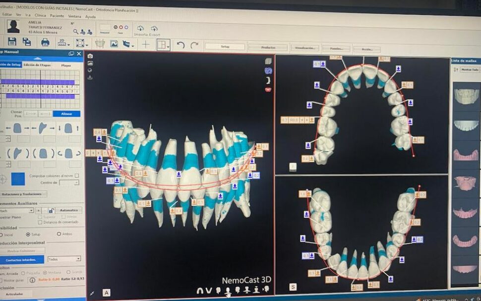 Software Nemocast de Nemotec e impresora 3D | Travesí Ortodoncia