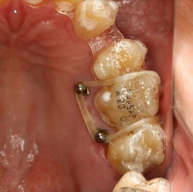 Microtornillos en ortodoncia ¿Para qué sirven? | travesiortodoncia.es