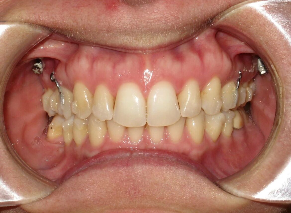 Microtornillos en ortodoncia ¿Para qué sirven? | travesiortodoncia.es