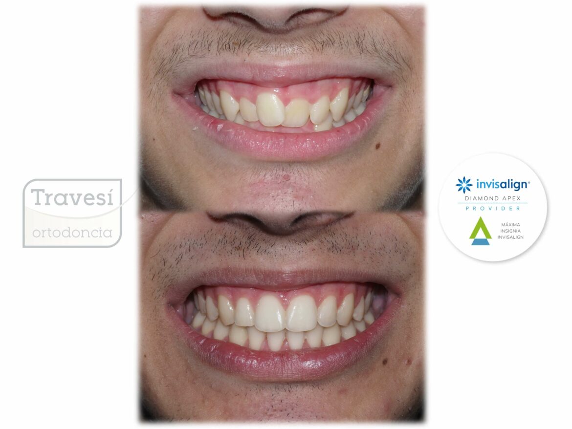 Sobremordida en niños: Cómo corregir + Imágenes del Antes y Después